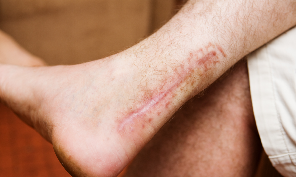 Fluoroquinolone antibiotics and adverse events