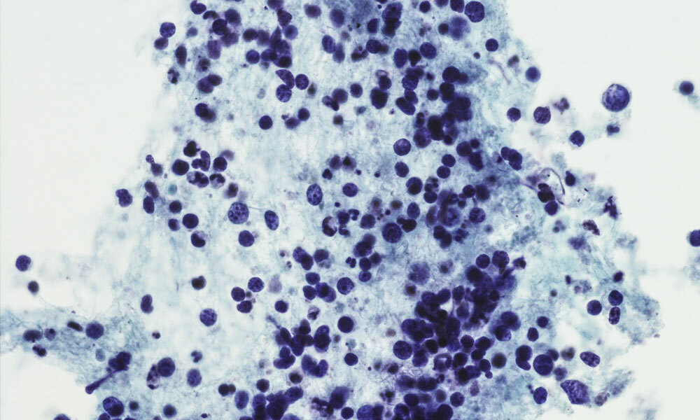 Lurbinectedin Small Cell