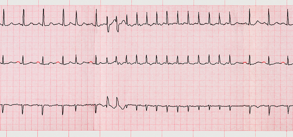 Atrial fibrillation: an update on management - Australian Prescriber