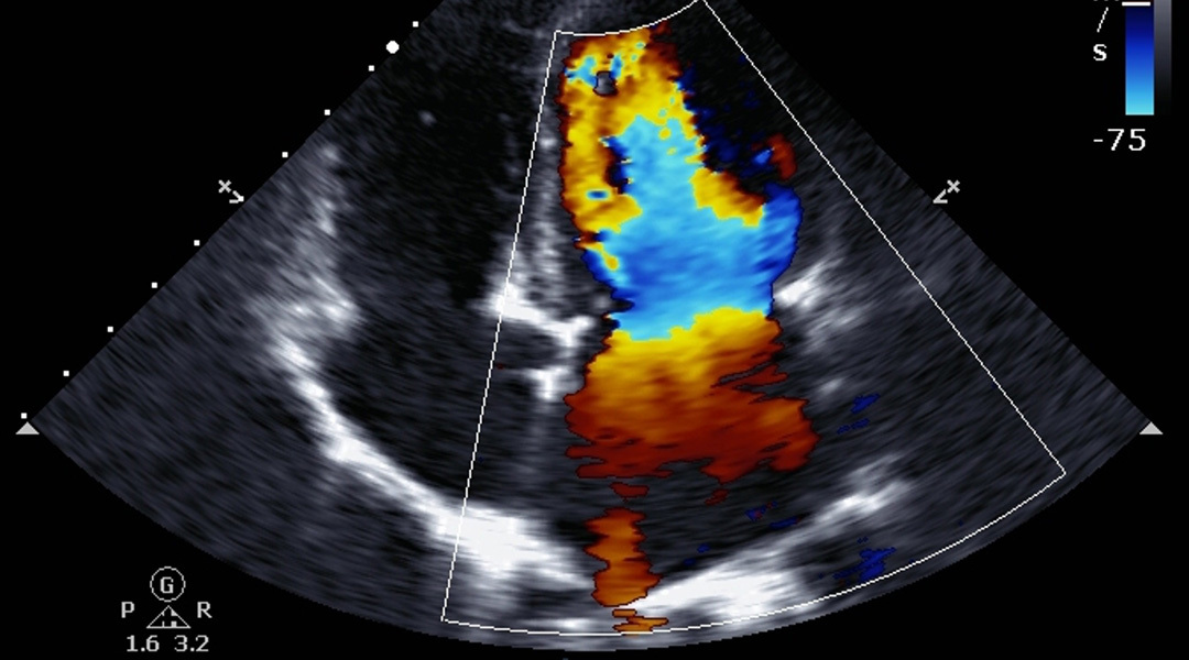 Demystifying echocardiography in heart failure: GP and cardiologist Q&A